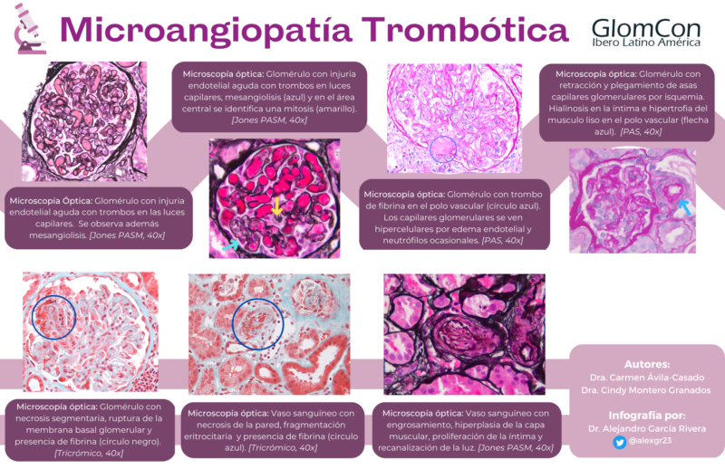 Patología de Microangiopatía Trombótica (MAT) – Ibero-Latino América