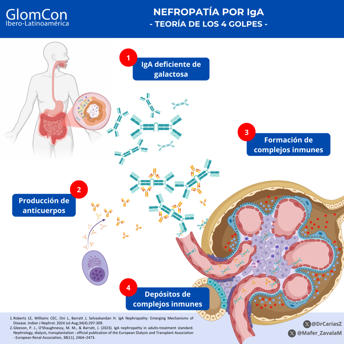 Nefropatía por IgA: de la Fisiopatología de los Cuatro Golpes a las ...
